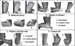 Kelainan Bawaan pada Kaki “CTEV (Congenital Talipes Equinovarus ...